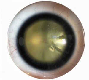 Cataract Surgery in India | Best Eye Specialists – ASG Eye Hospital