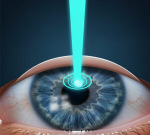 LASIK Eye Surgery in India | Best Eye Specialists – ASG Eye Hospital