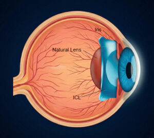 ICL Surgery in India – Implantable Collamer Lens | ASG