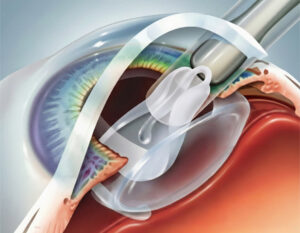 Cataract Surgery in India | Best Eye Specialists – ASG Eye Hospital