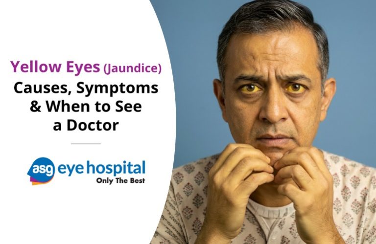 Yellow Eyes Jaundice: Causes, Symptoms & Treatment